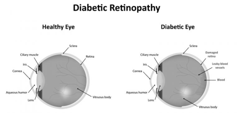 Diabetic Eye Disease - Symptoms & Treatment | Binetter Eye Centre